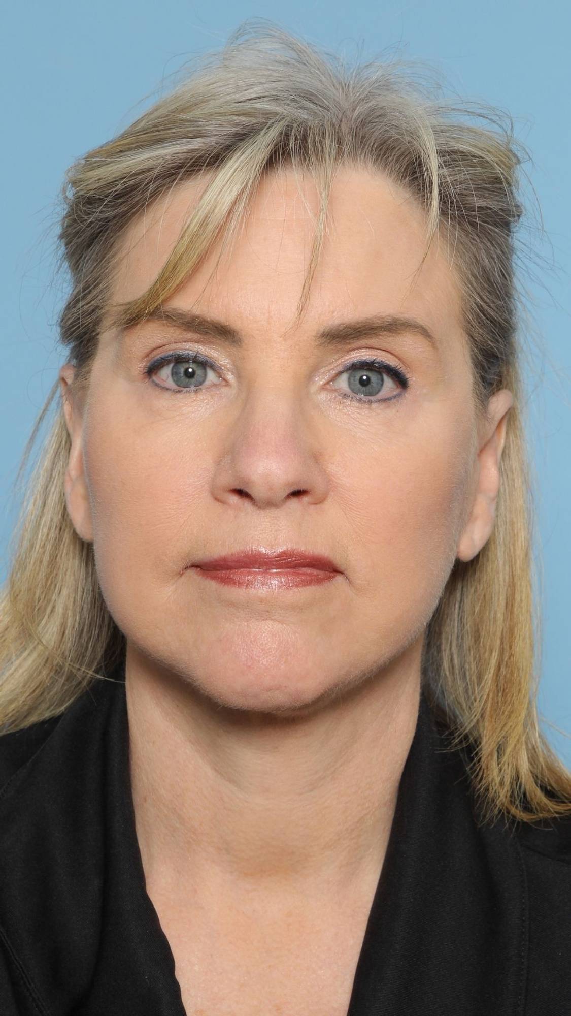 Patient 1 Neck Lift Before & Afters | Austin-Weston