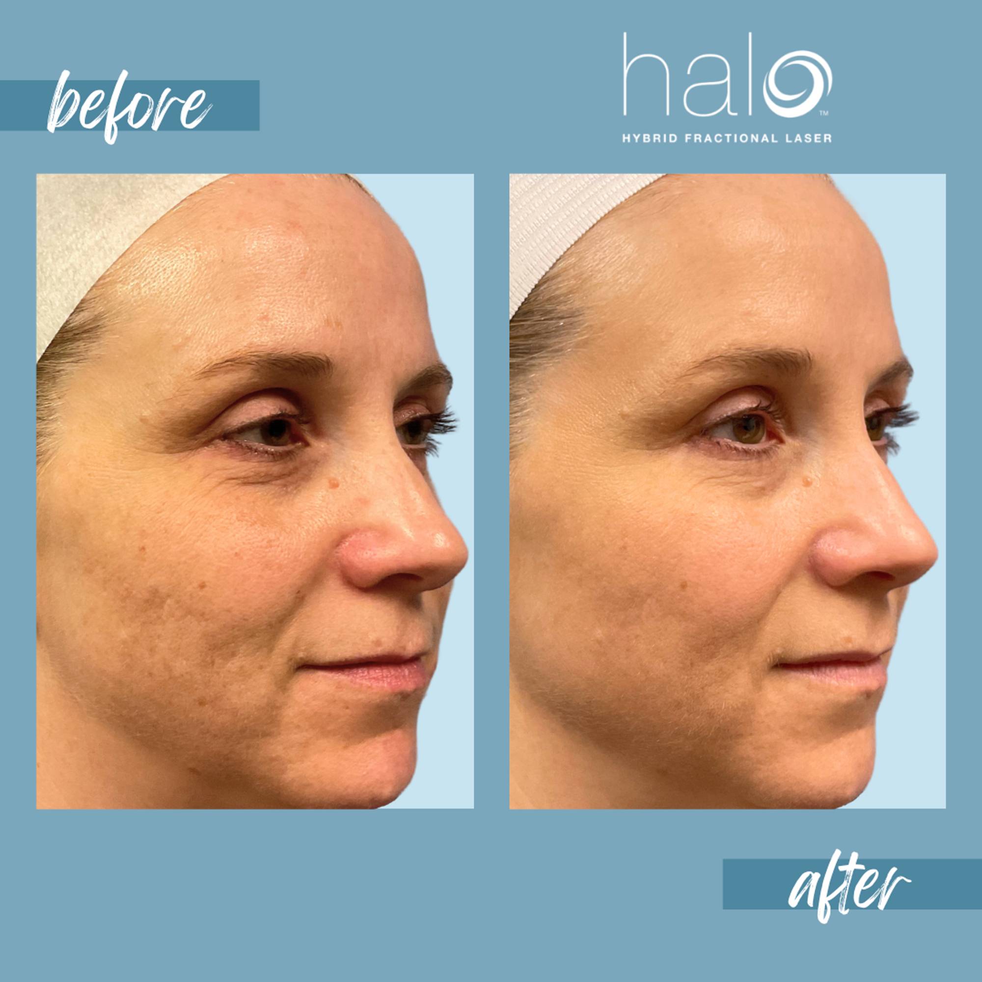 HALO Laser Before Afters Rejuvenate Colorado HALO Laser Before Afters Rejuvenate Colorado