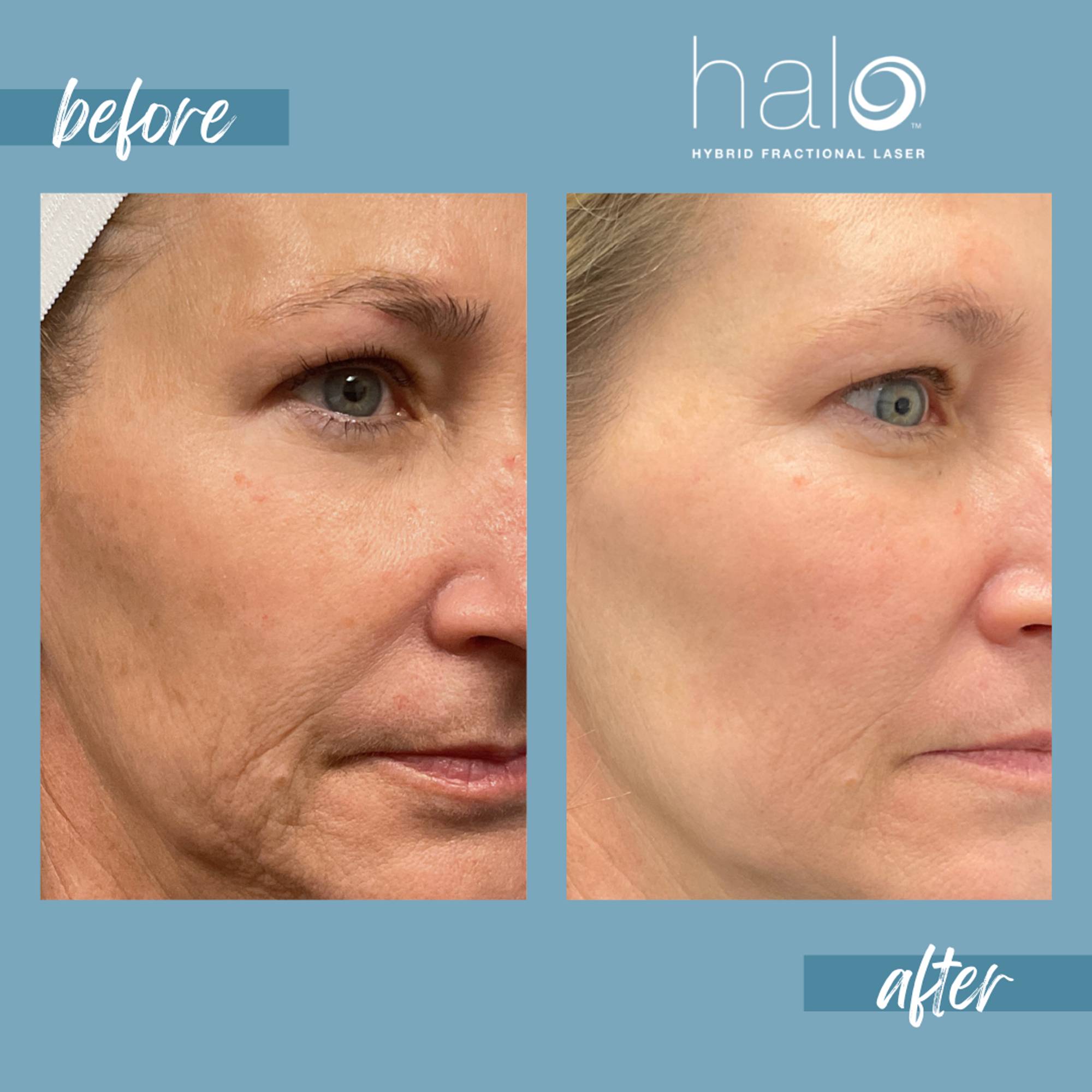 HALO Laser Before Afters Rejuvenate Colorado HALO Laser Before Afters Rejuvenate Colorado