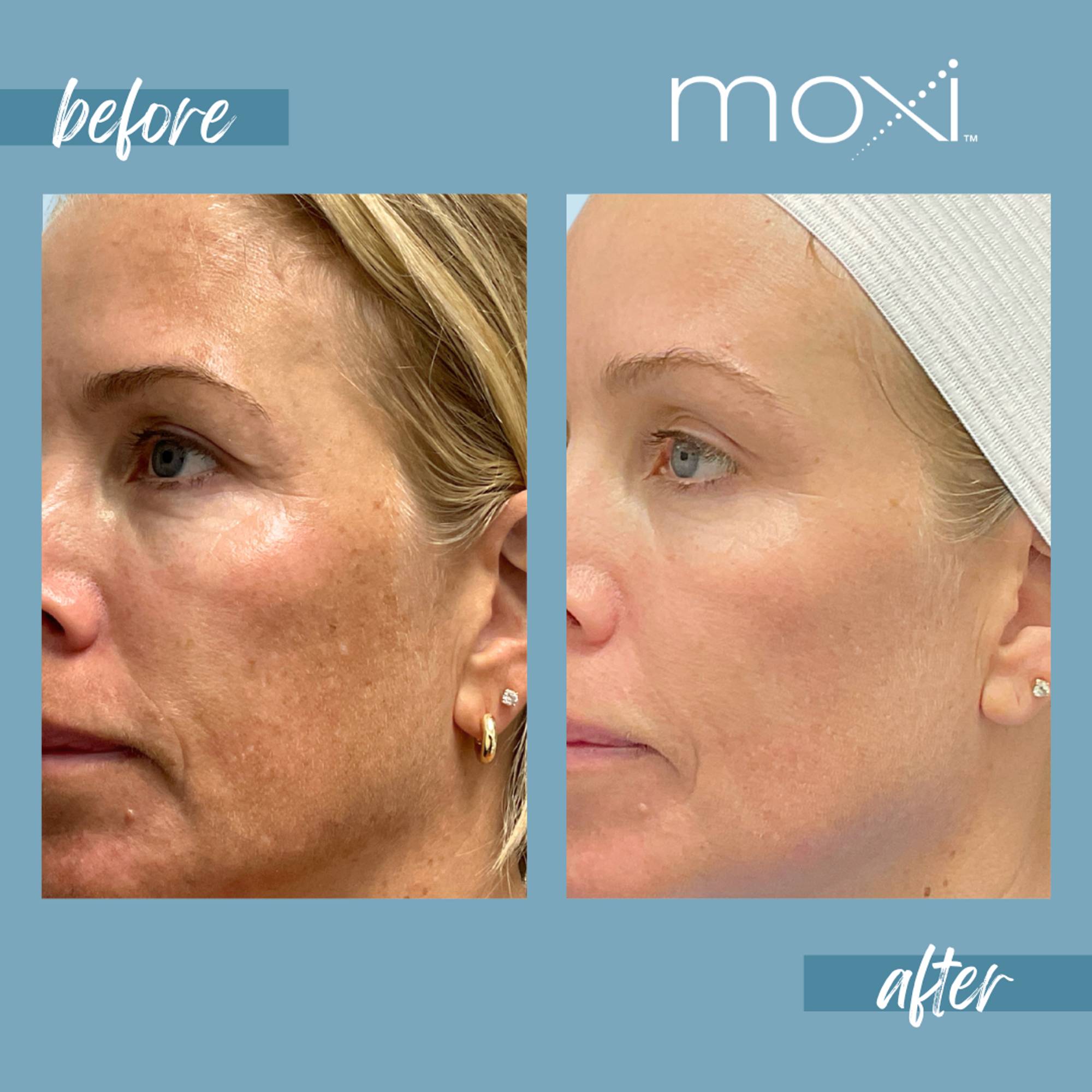 MOXI Laser Before Afters Rejuvenate Colorado MOXI Laser Before Afters Rejuvenate Colorado
