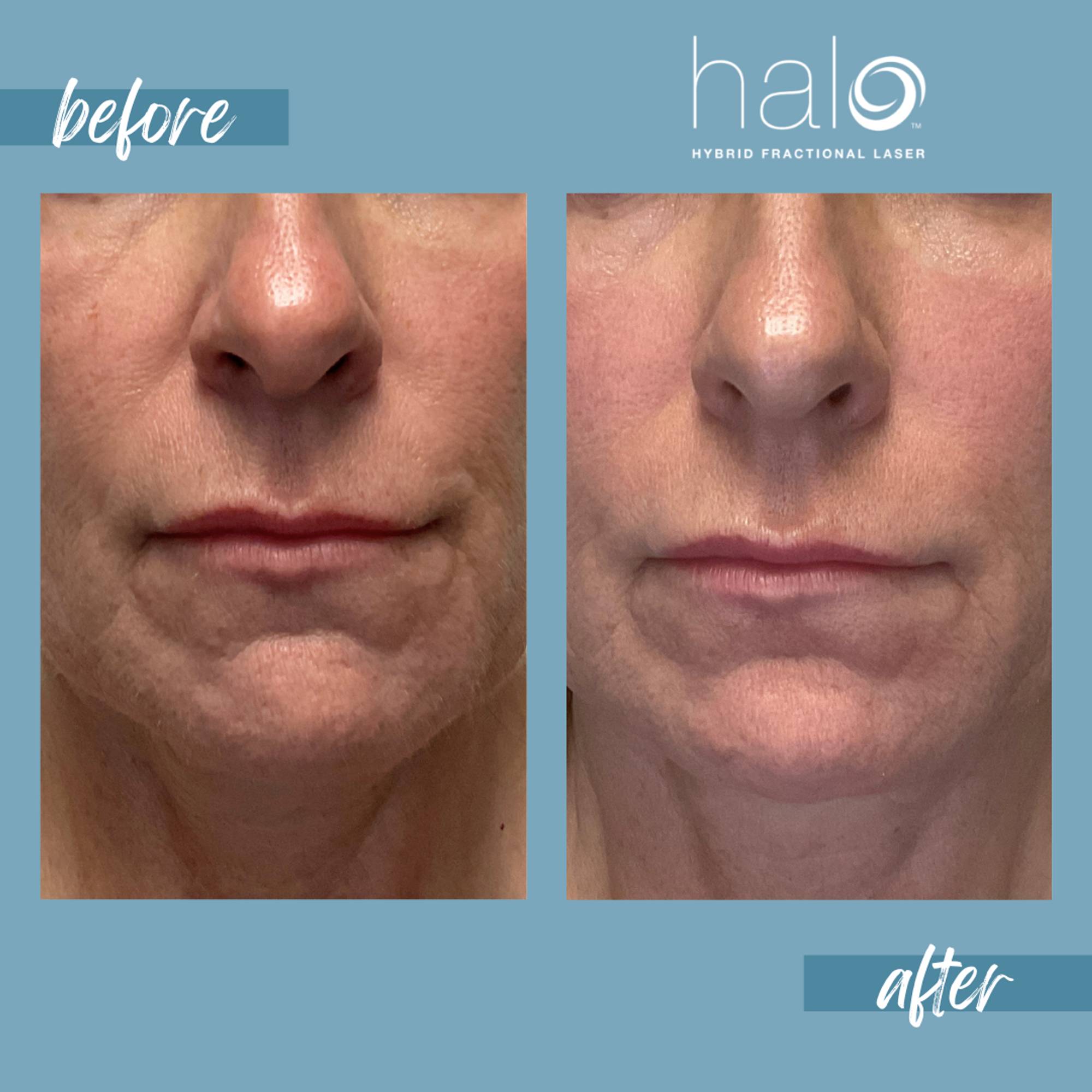 HALO Laser Before Afters Rejuvenate Colorado HALO Laser Before Afters Rejuvenate Colorado